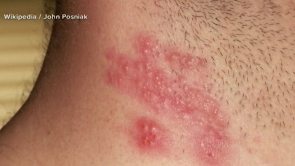 Know the warning signs of Shingles – Eyewitness News (WEHT/WTVW)